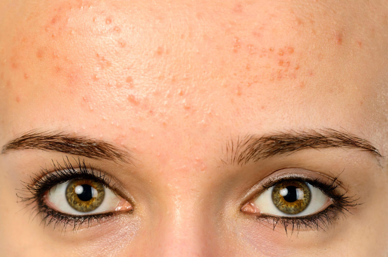 Pickel auf der Stirn: Ursachen & Lösungen